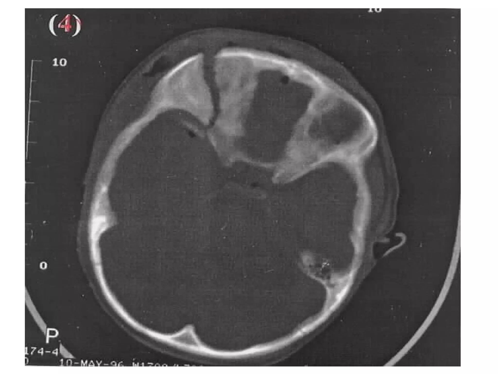 Minor and moderate head injuries in children | PPT