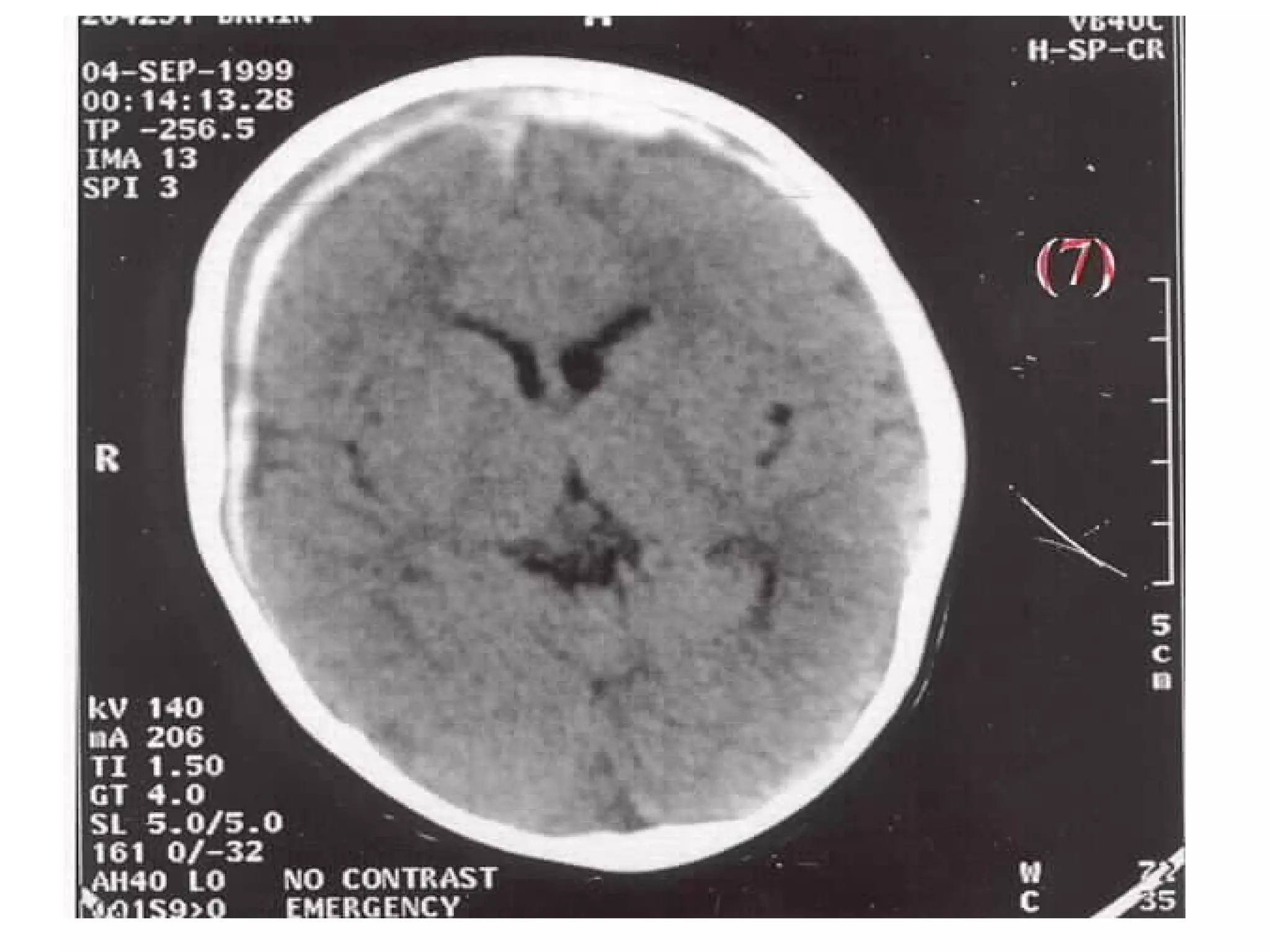 Minor and moderate head injuries in children | PPT