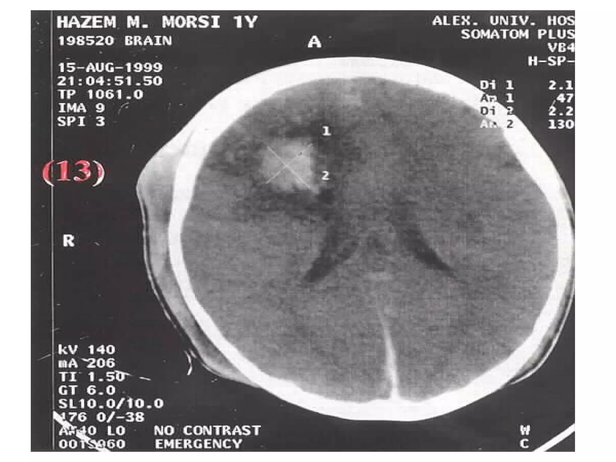 Minor and moderate head injuries in children | PPT