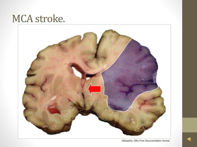 Stroke [uncensored] - by MHR Corporation | PPT