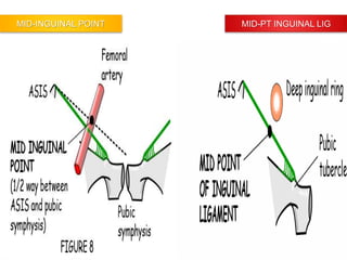 Mid Inguinal Line