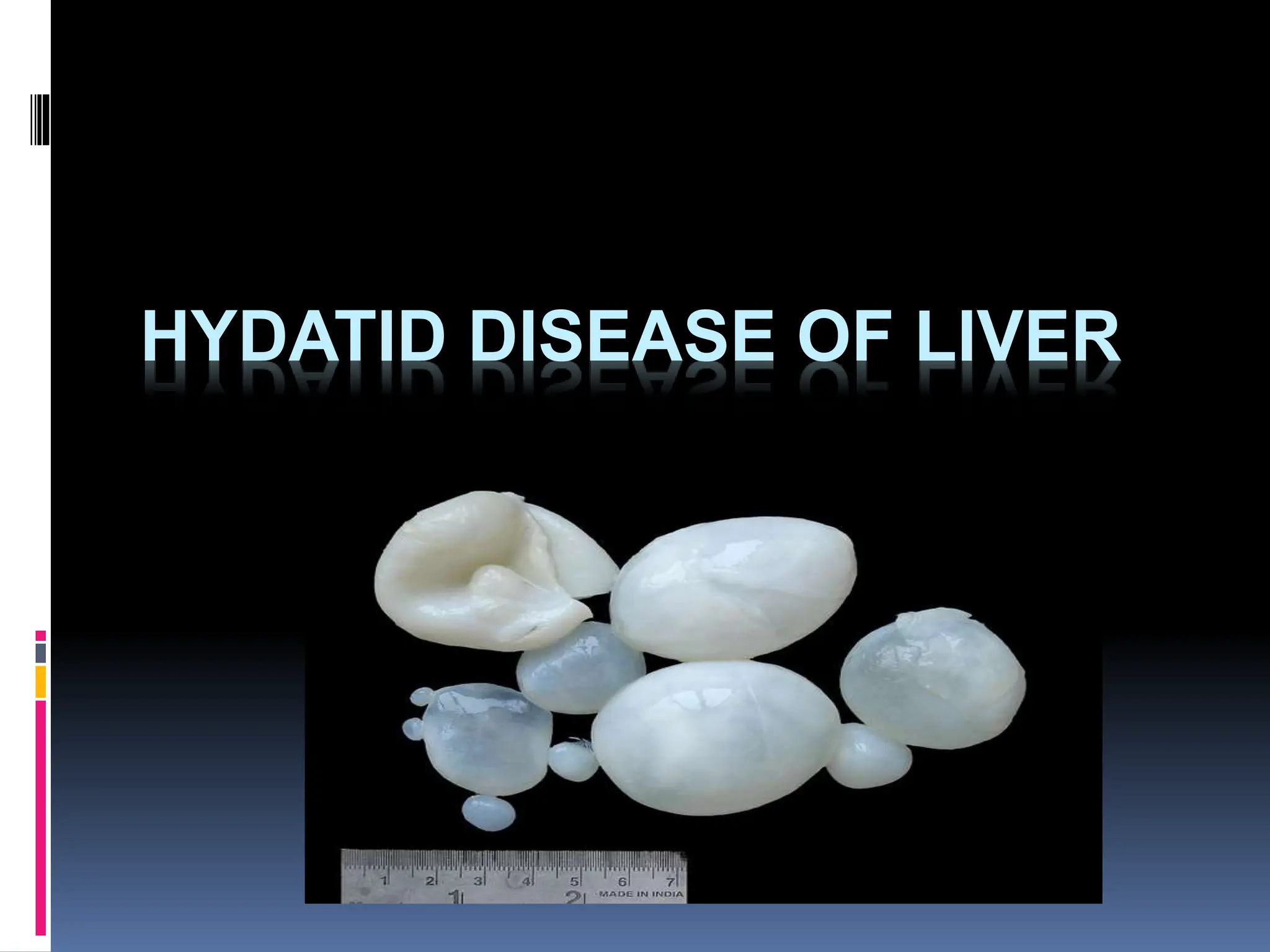 M Hussnain Raza, Hydatid Disease of Liver.pptx