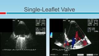 Mechanical Heart Valves | PPTX