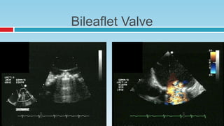 Mechanical Heart Valves | PPTX