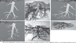 MHV venous anatomy liver,MHV for liver transplantation.pptx