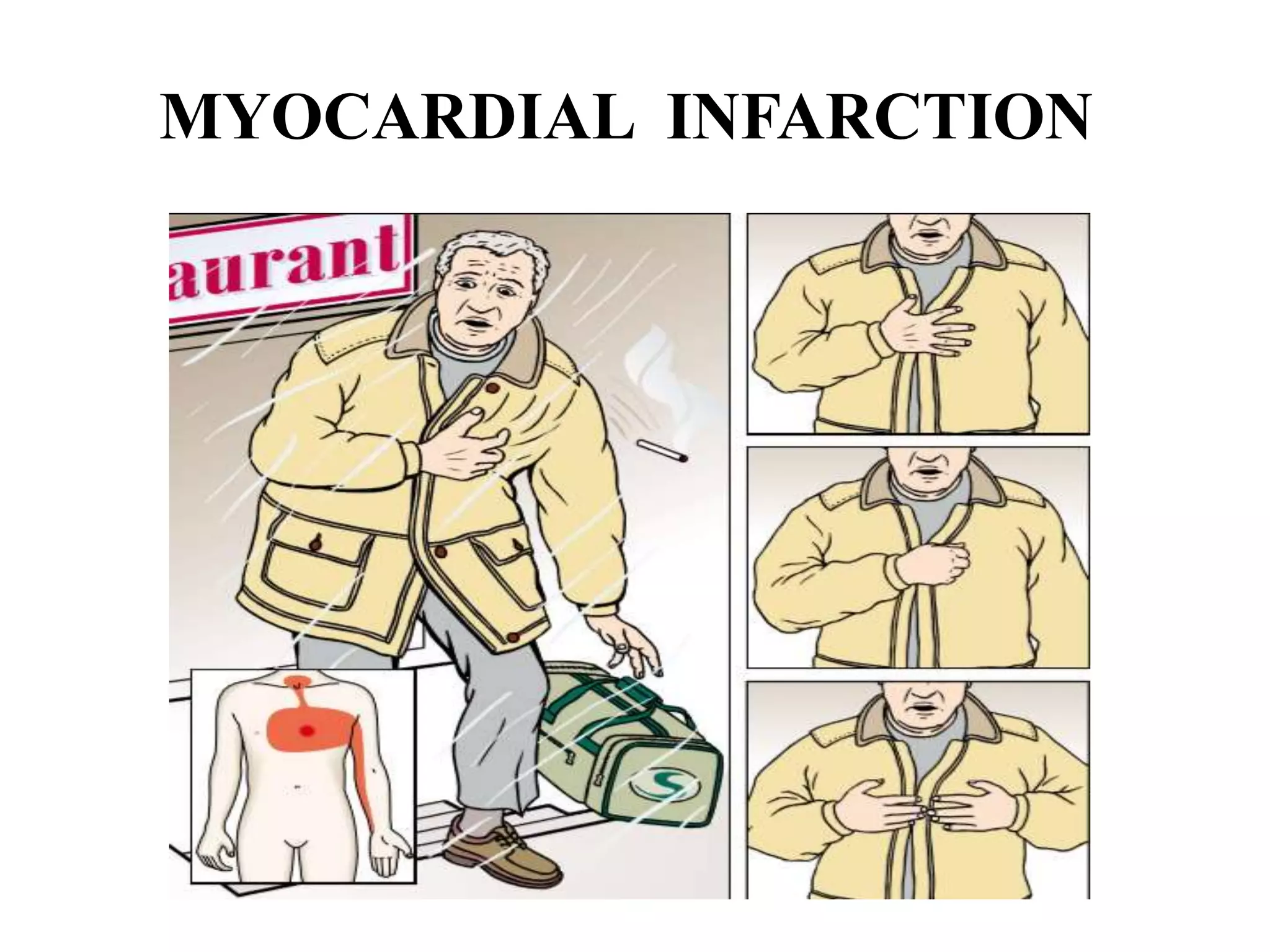 Cardiac markers in Myocardial infarction (MI) | PPT