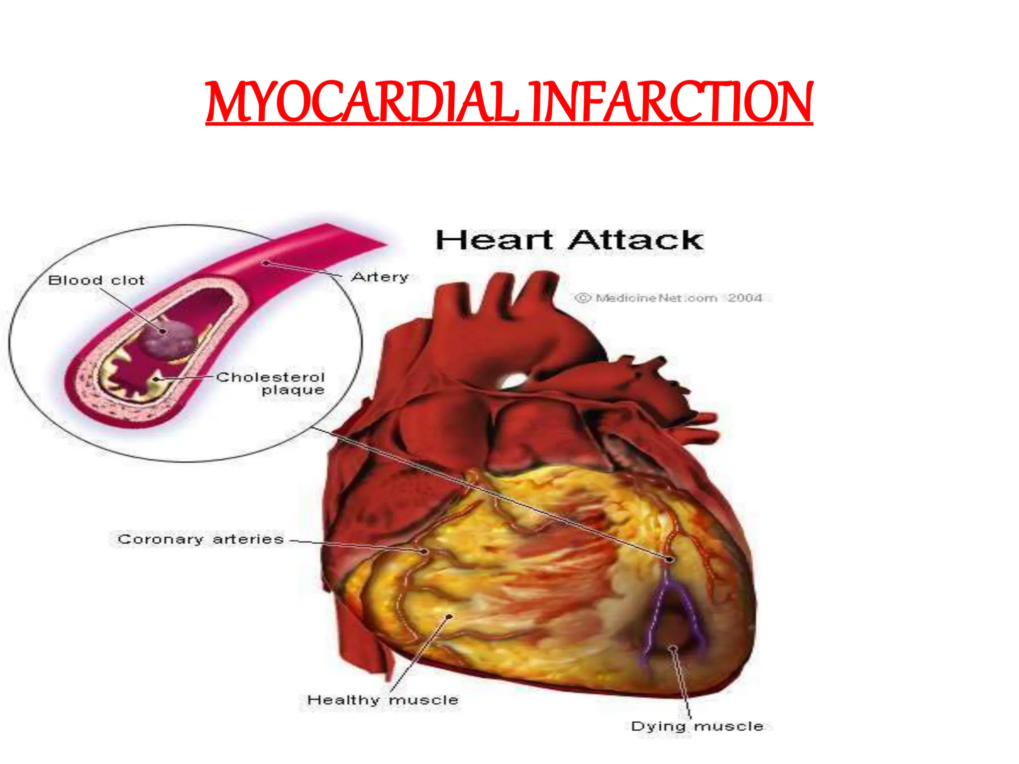 Myocardial Infraction -cardiac system disorder .pptx