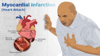 Myocardial Infarction Power point presentation | PPTX