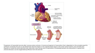 Comprehensive Case Study and Pathogenesis of Acute STEMI in a Diabetic ...
