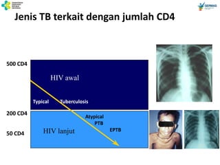Penyuluhan Kesehatan Tata Laksana TB dan HIV | PDF