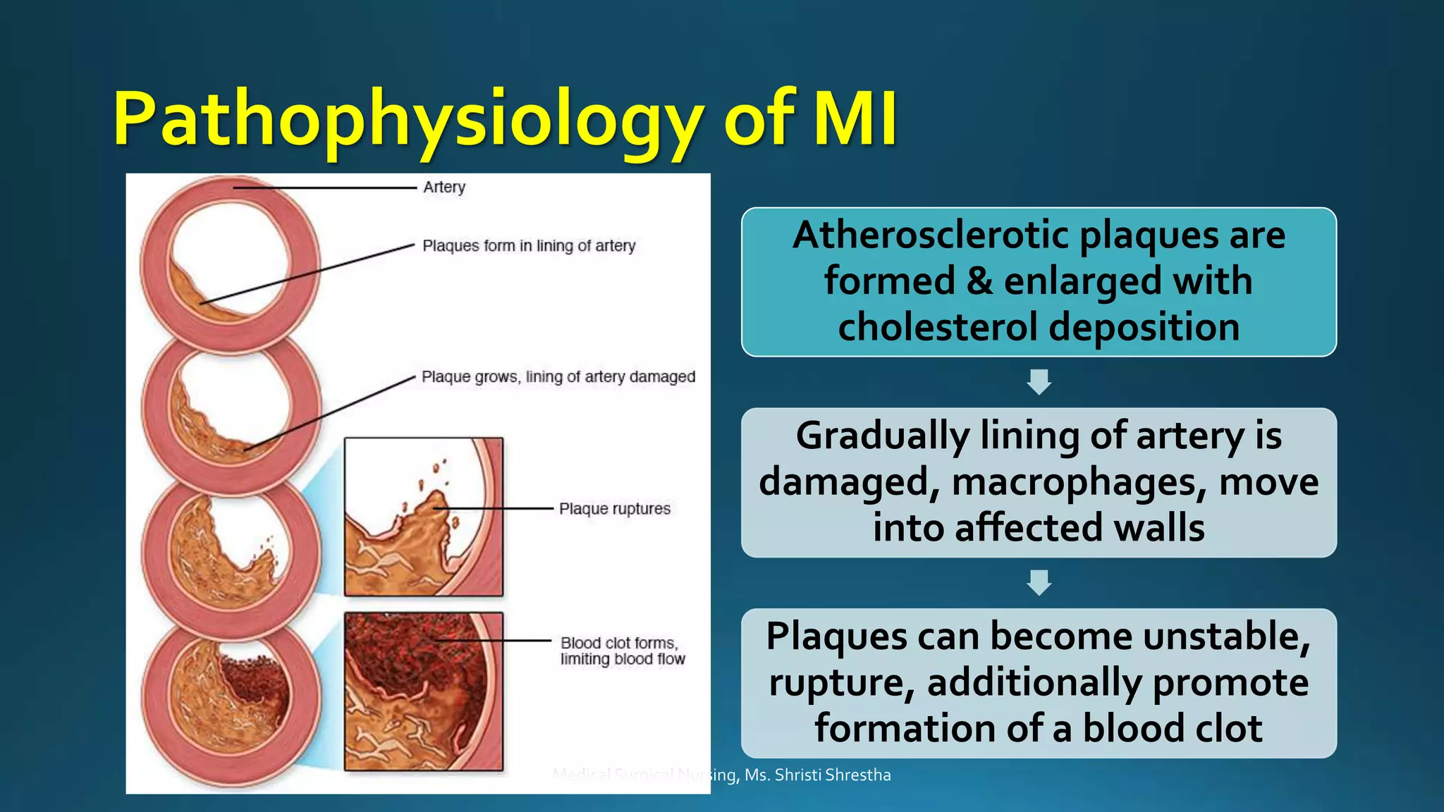 Acute Coronary Syndrome: MI | PPTX