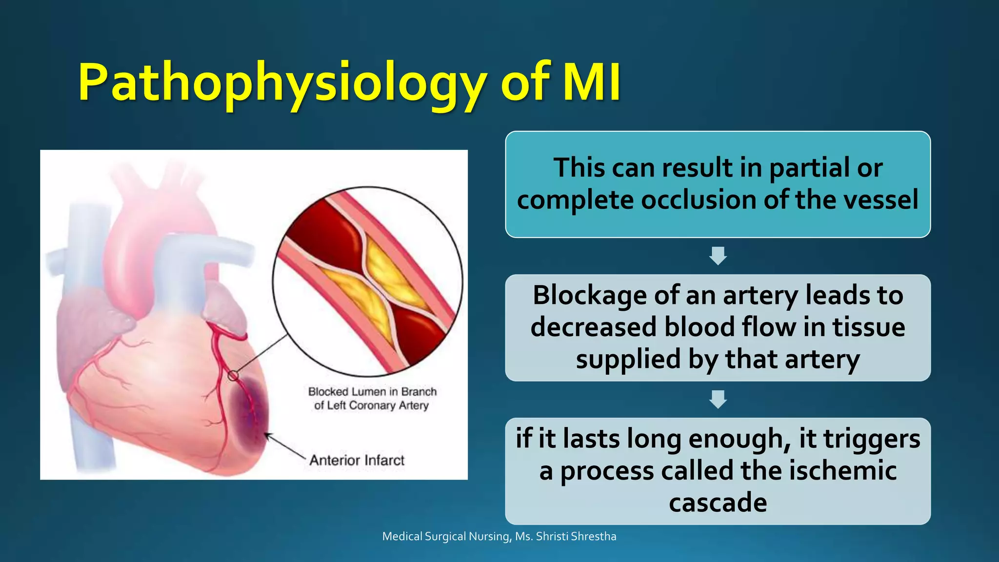 Acute Coronary Syndrome: MI | PPTX