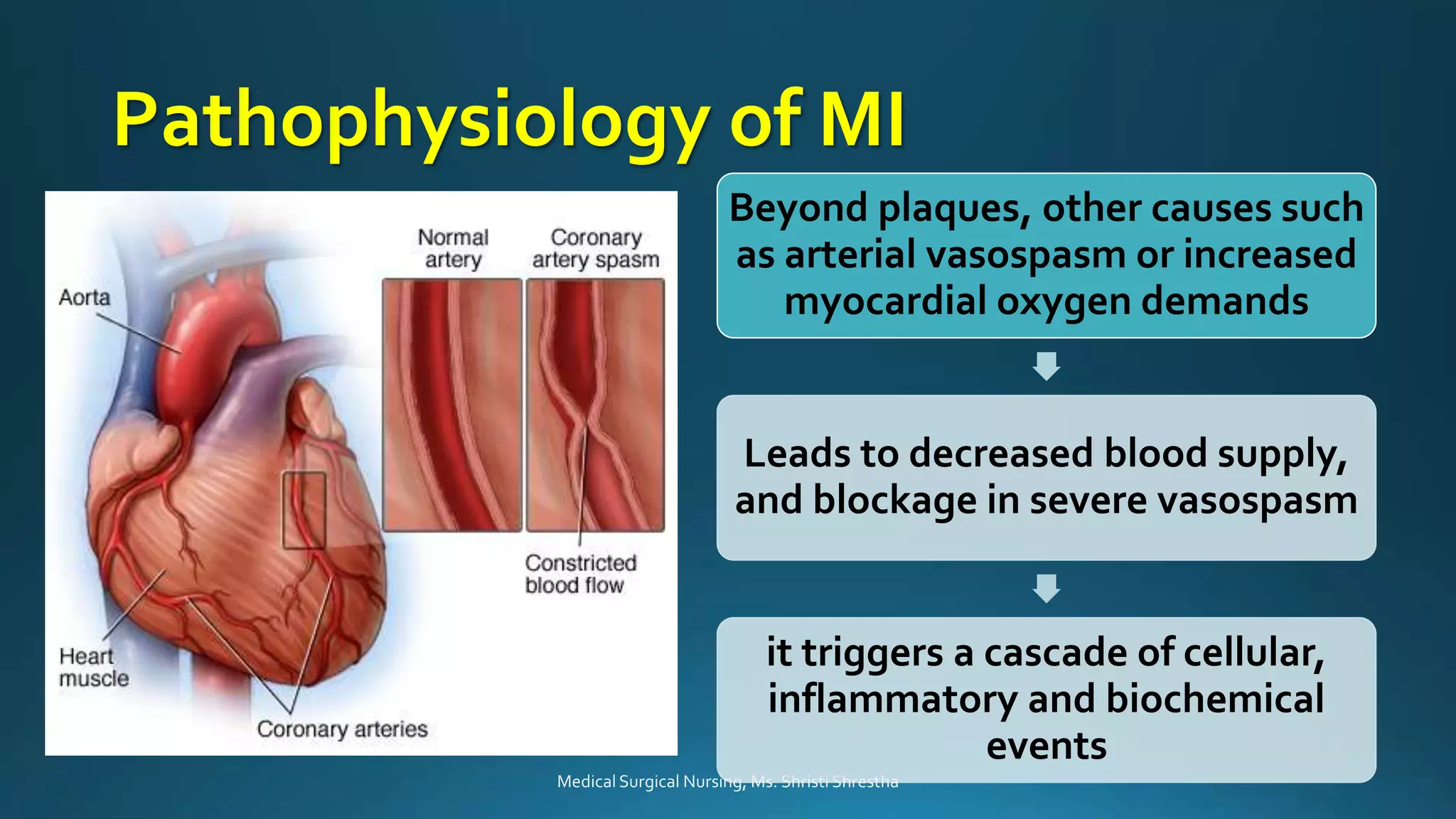 Acute Coronary Syndrome: MI | PPTX