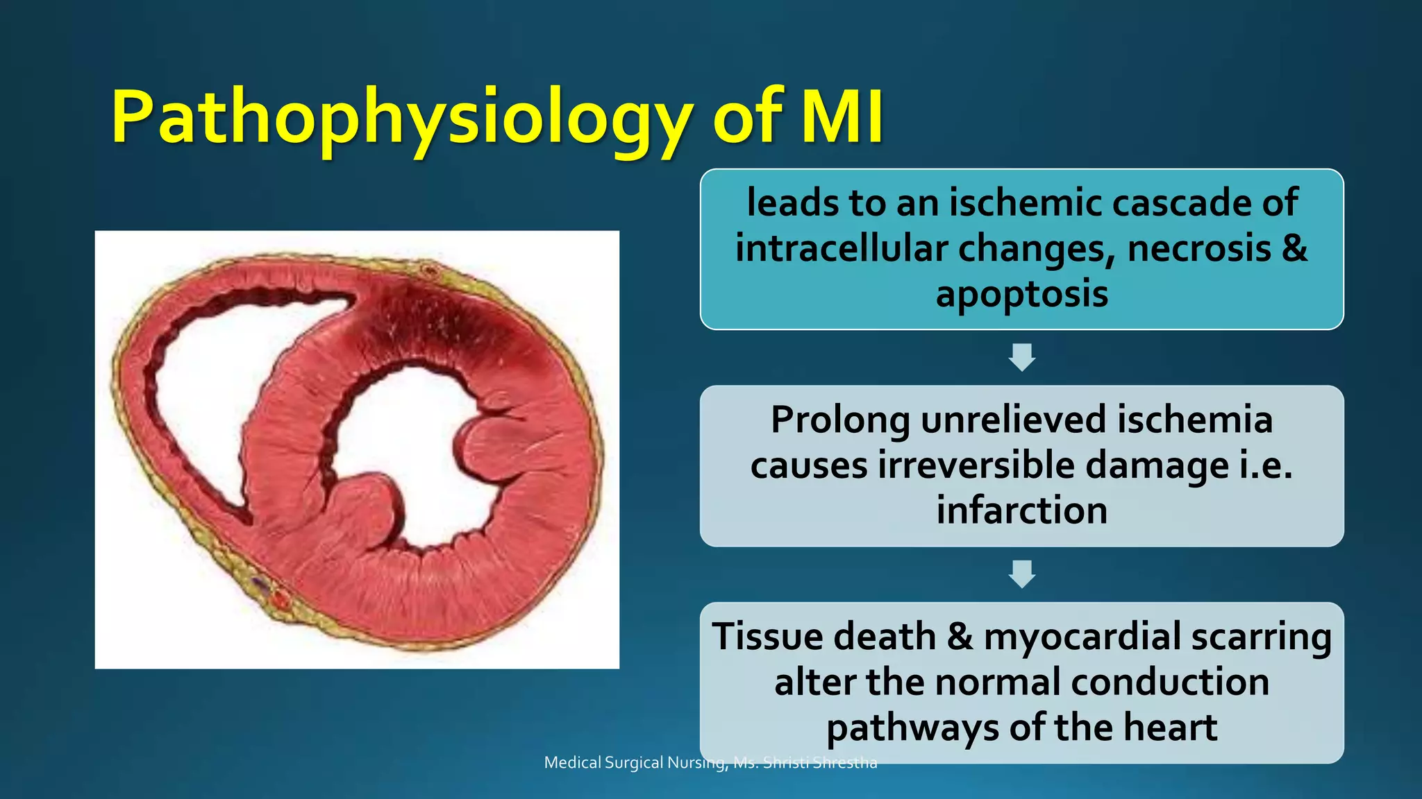 Acute Coronary Syndrome: MI | PPTX