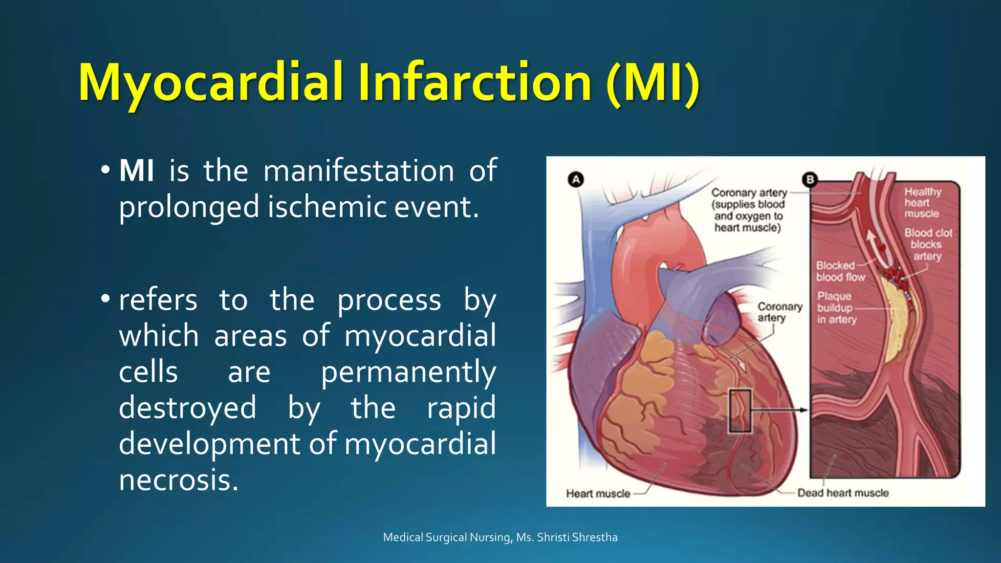 Acute Coronary Syndrome: MI | PPTX