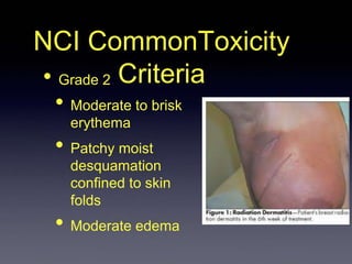 Miaderm® Radiation Relief Lotion & Miaderm-L | PPT