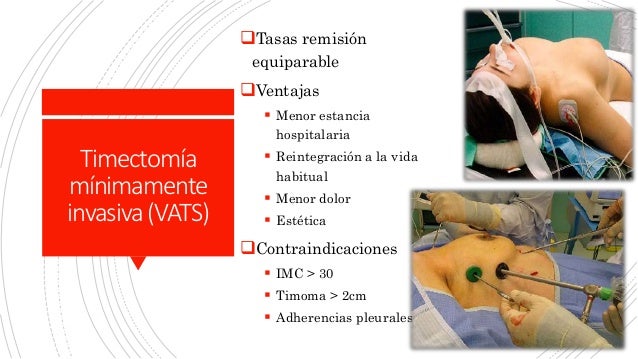 Miastenia gravis Miastenia gravis