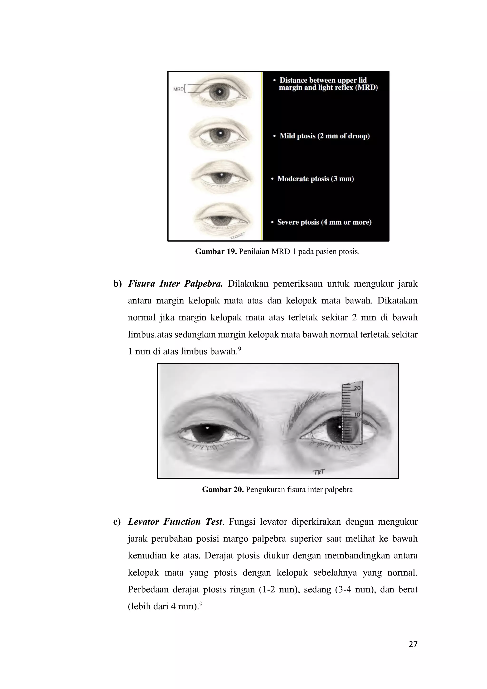 Miastenia Gravis Okular - FDI.pdf