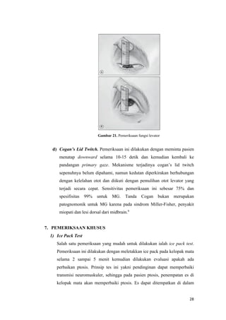 Miastenia Gravis Okular - FDI.pdf