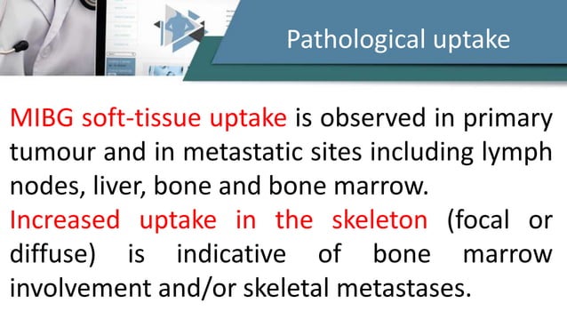 MIBG scan presentation | PPTX