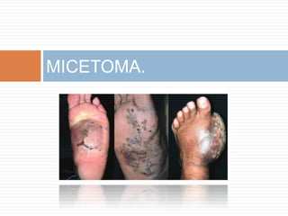 Micetoma Pptx