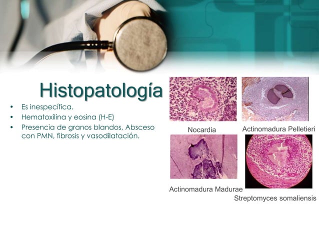 Micetoma: Actinomicetoma y Eumicetoma Dermatologia
