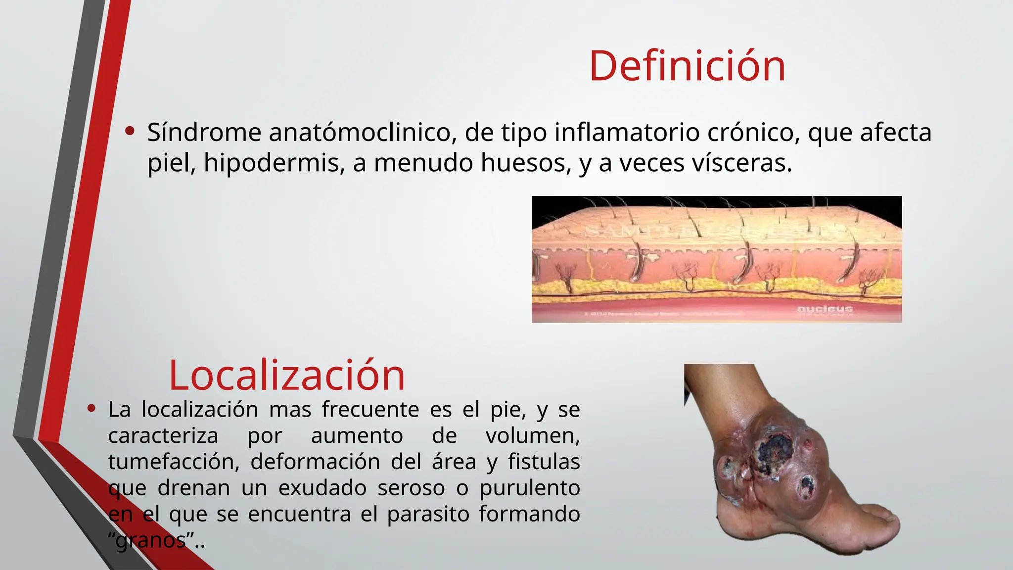 MICETOMA COMO ENFERMEDAD TROPICAL EN AMERICA | PPTX