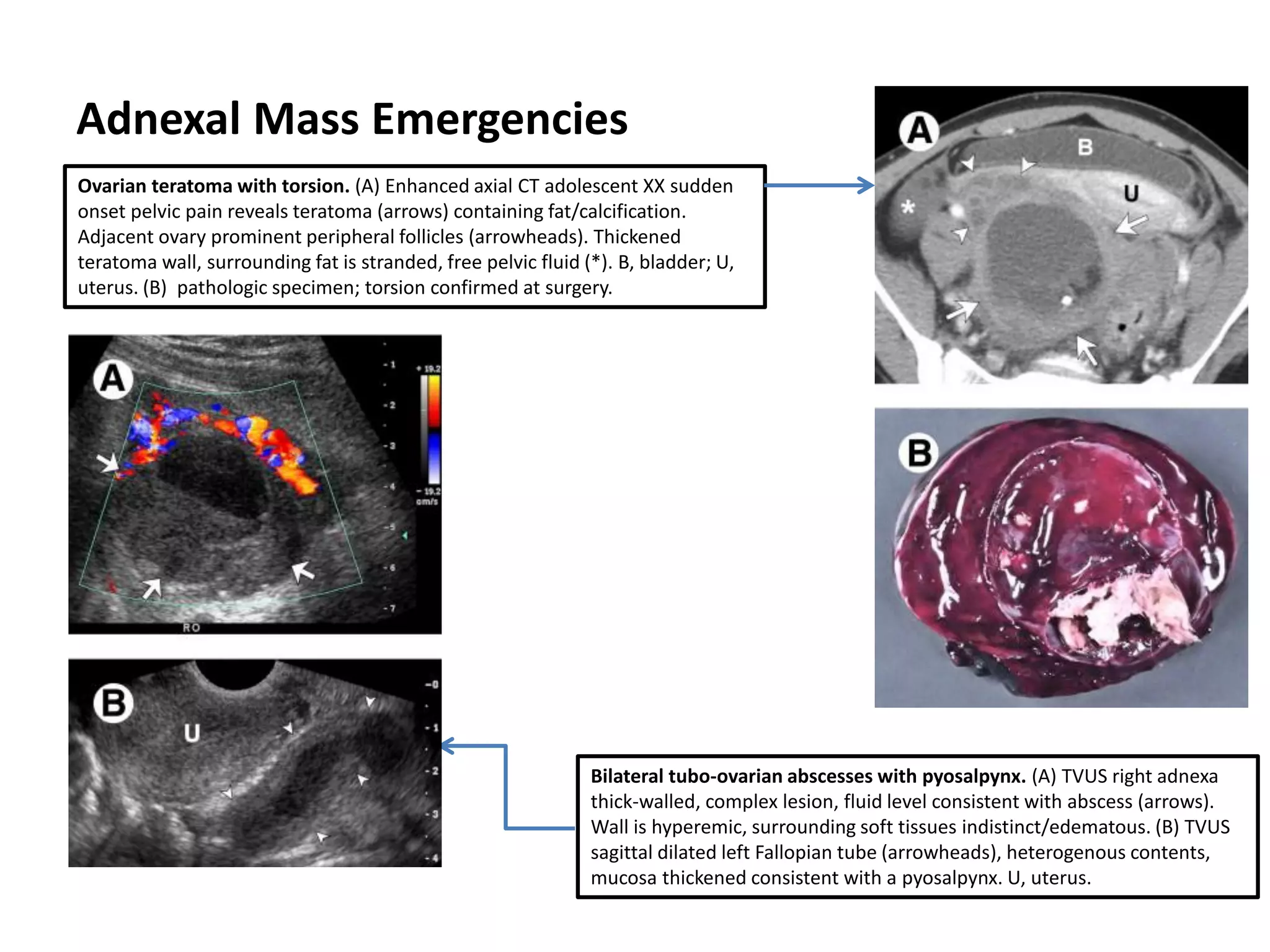 Adnexal masses - Ovarian Cysts (2008) | PDF