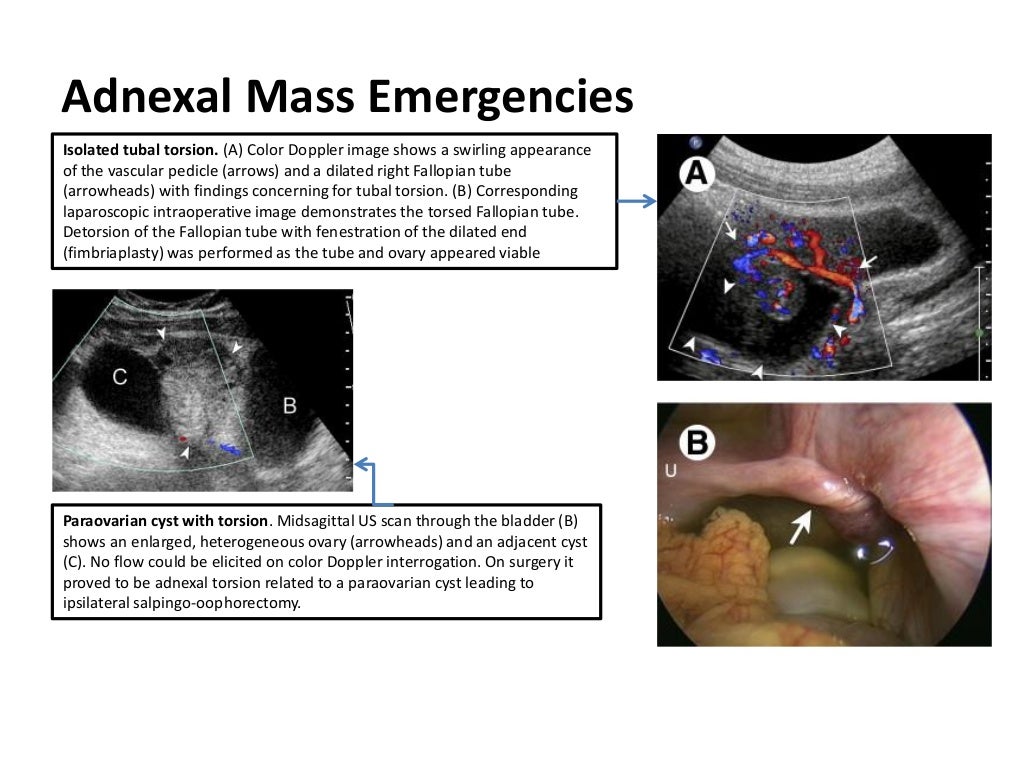 Adnexal masses - Ovarian Cysts (2008)