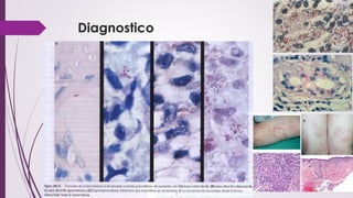 Micobacterium leprae | PPTX