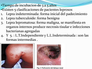 Micobacterium leprae orlando | PPTX
