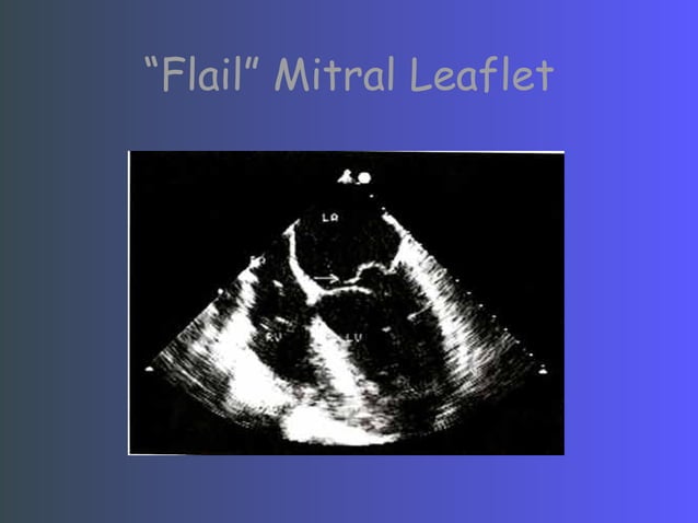 complications of acute myocardial infraction | PDF