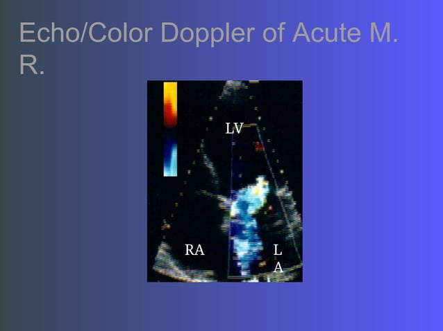 complications of acute myocardial infraction | PDF