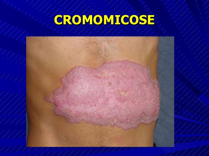 Micoses subcutâneas