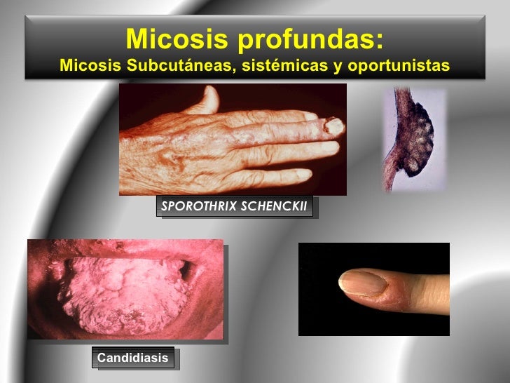 Micosis