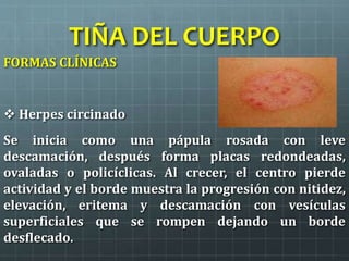 (2017-03-09)Micosis superficiales (PPT) | PPTX