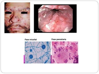 Micosis | PPTX