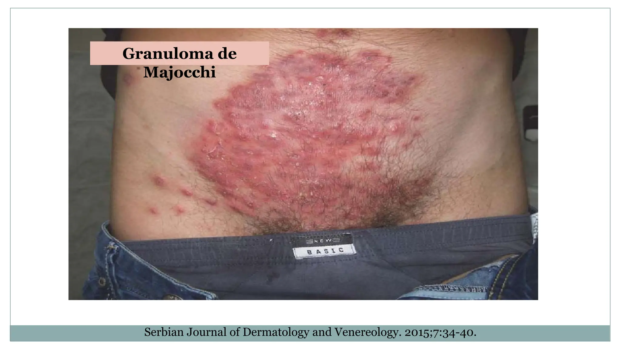 Dermatofitos, cómo enfermedad de etiología fungica en crecimiento. | PPT