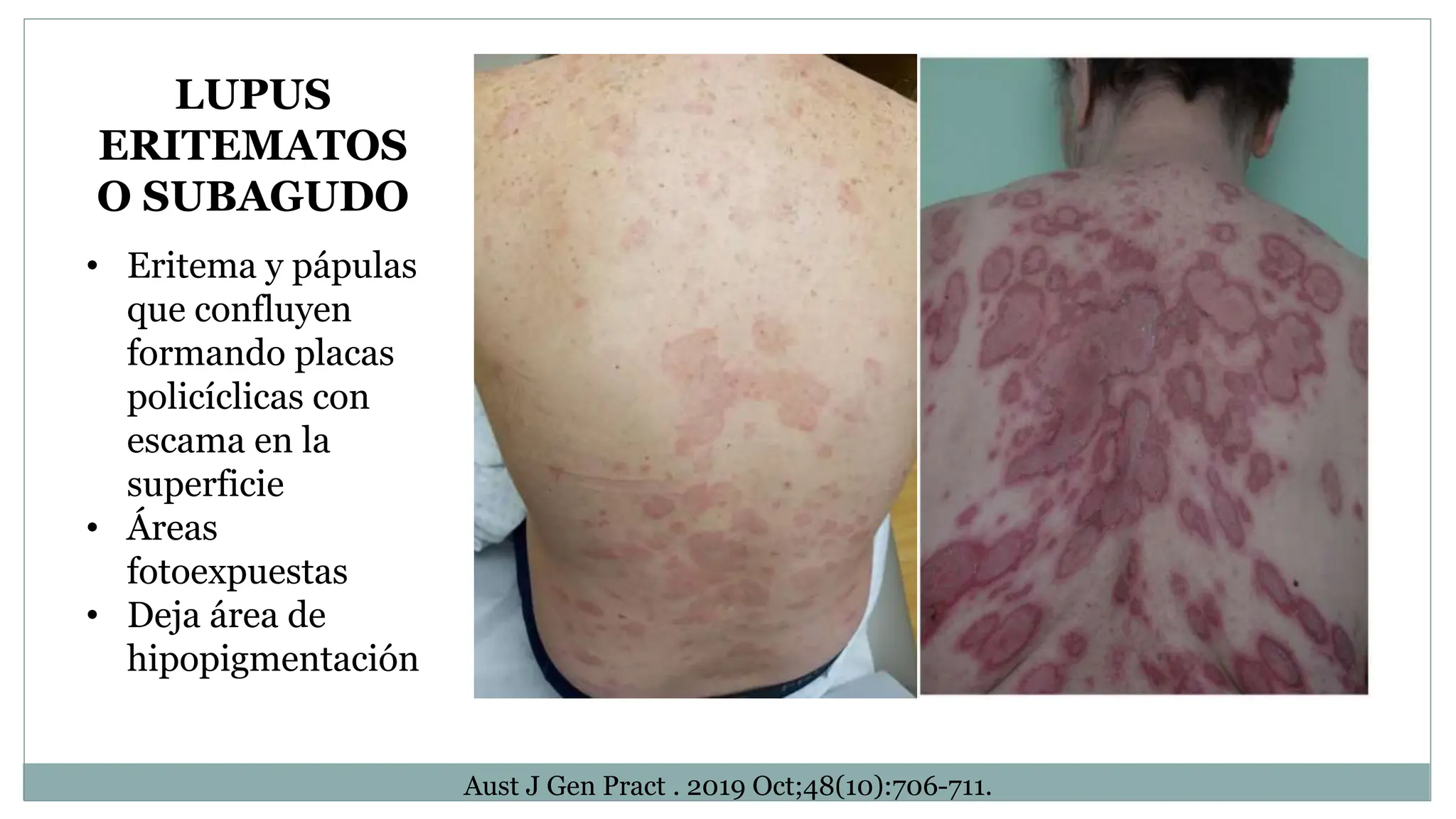Dermatofitos, cómo enfermedad de etiología fungica en crecimiento. | PPT