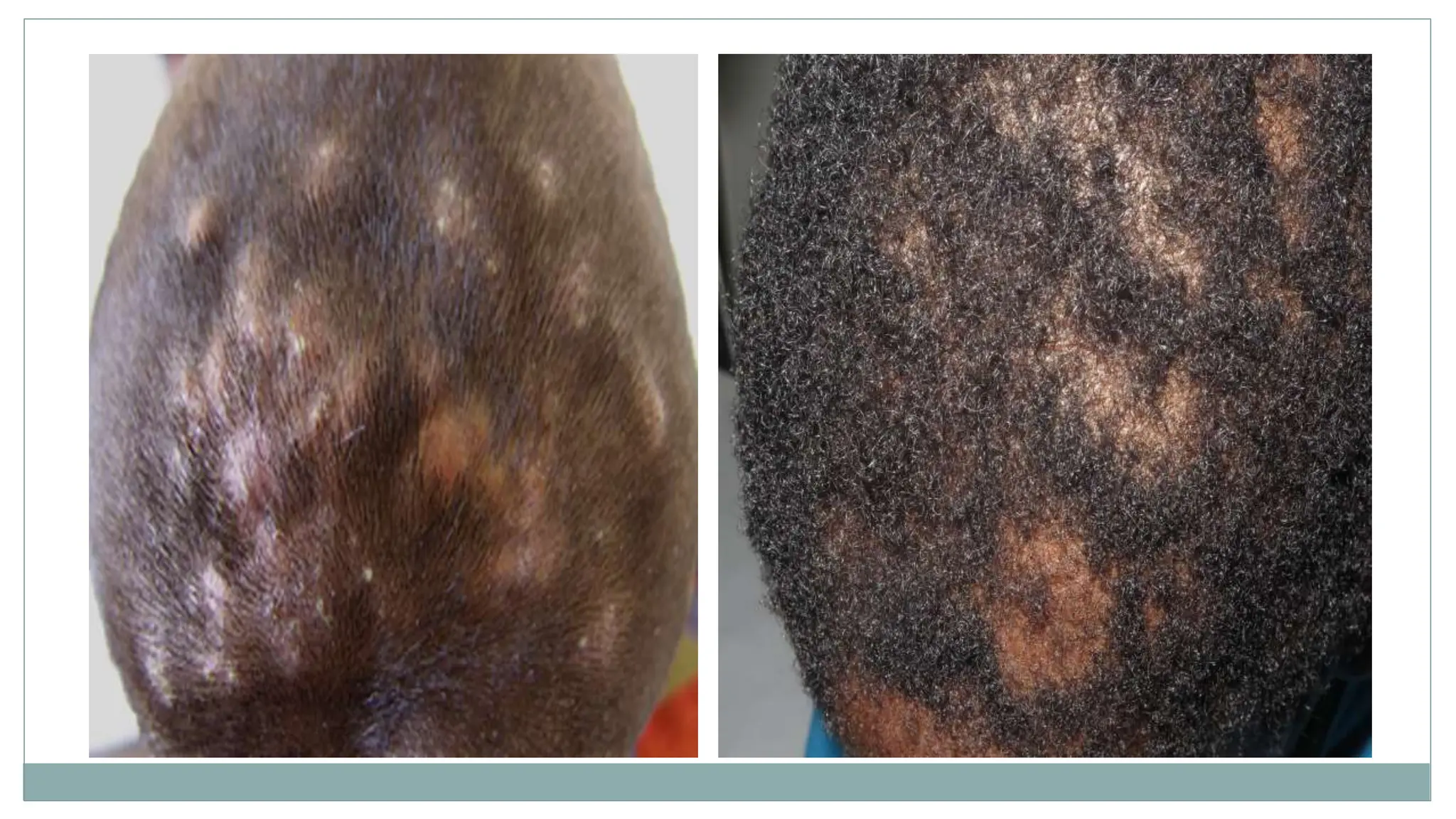 Dermatofitos, cómo enfermedad de etiología fungica en crecimiento. | PPT