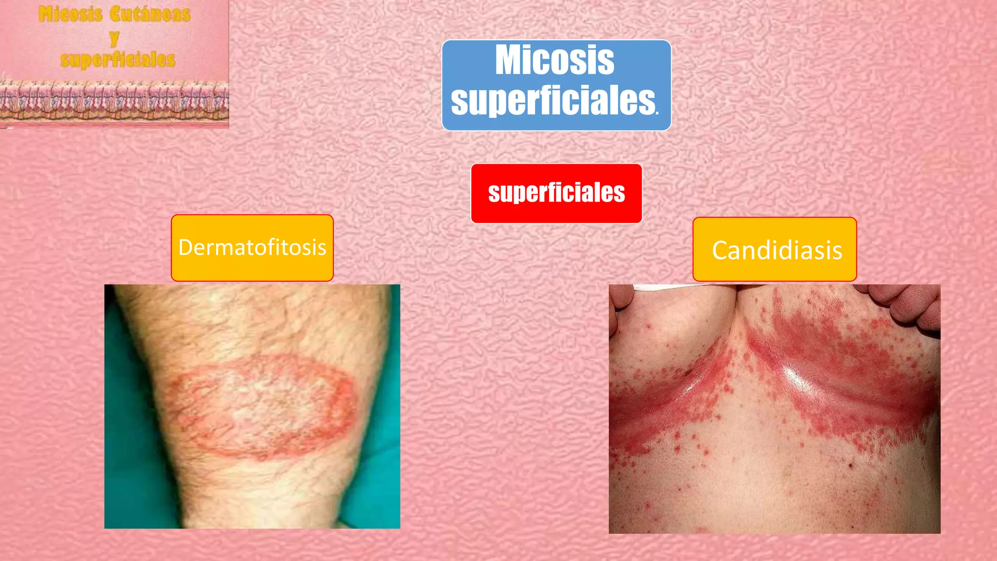 Micosis superficiales y cutáneas | PPTX