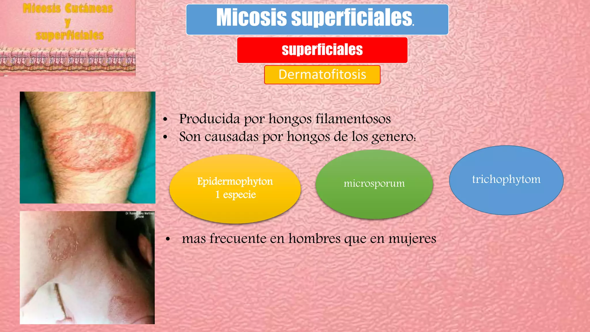 Micosis superficiales y cutáneas | PPTX