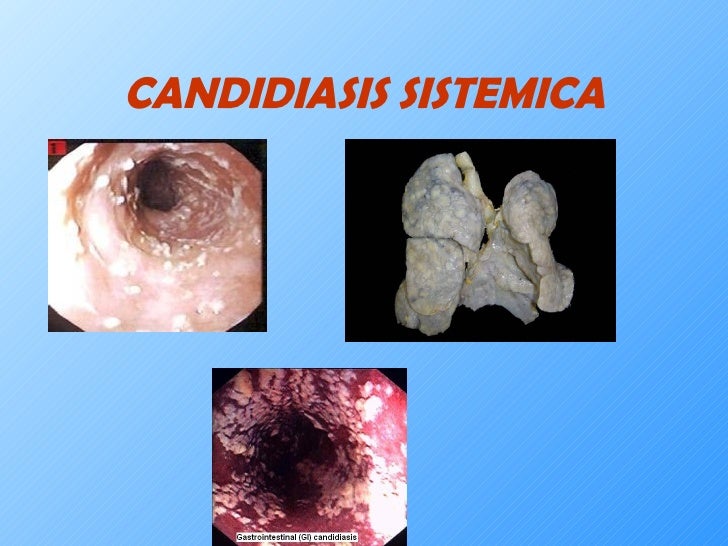 Micosis Profundas