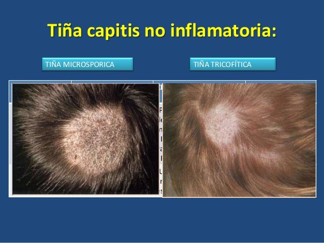 Dermatofitosis Dermatofitosis