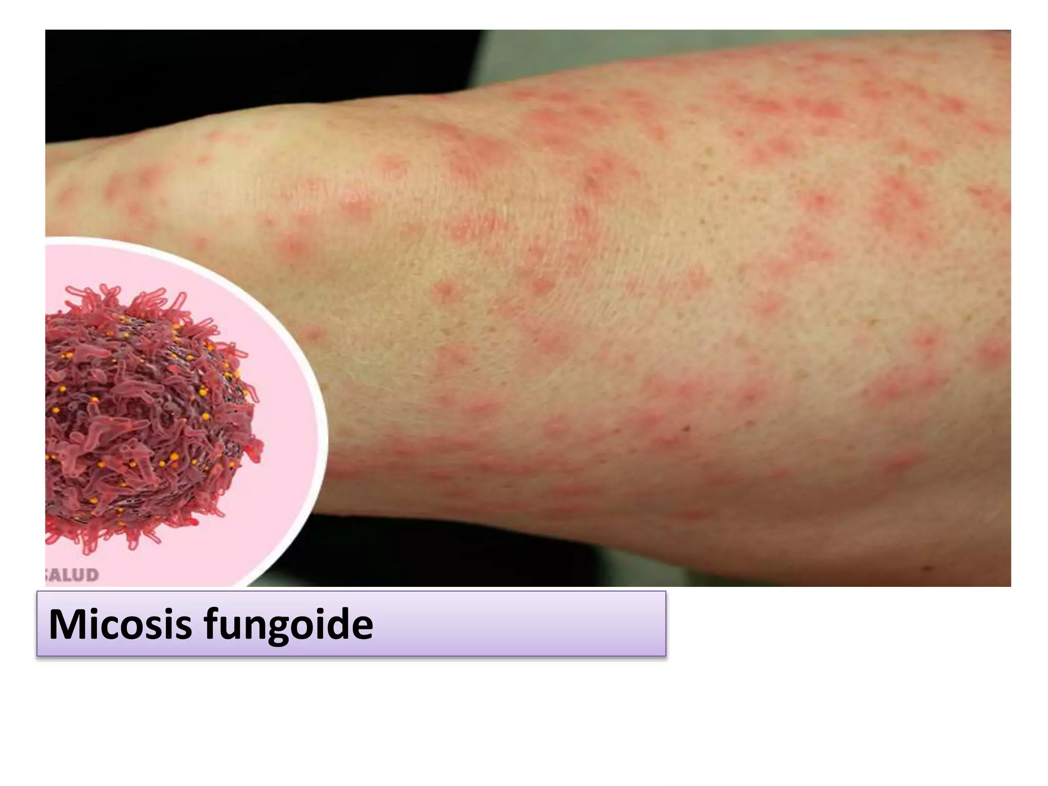 Micosis fungoide | PPTX