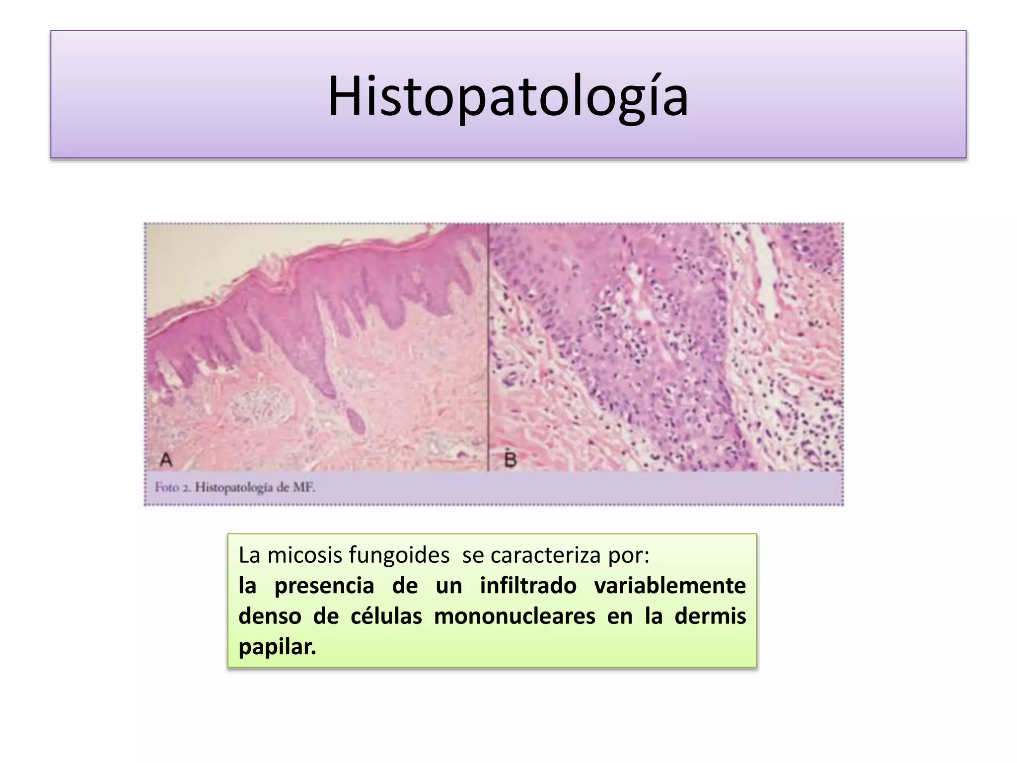 Micosis fungoide | PPTX