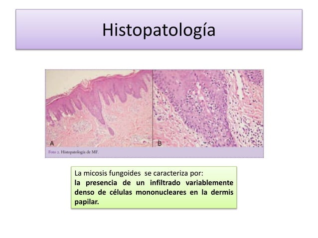 Micosis Fungoide Ppt