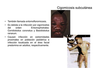 Micosis subcutáneas | PPTX