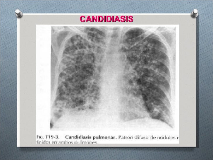 MICOSIS PULMONARES. DR CASANOVA
