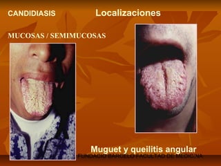 Micosis superficiales | PPT